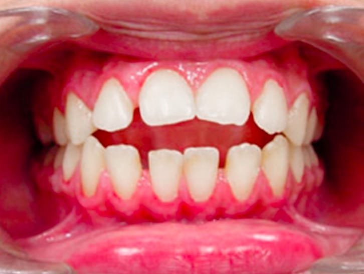Mordida Aberta - Como Corrigir, Tratar e Fechar a Mordida Aberta?