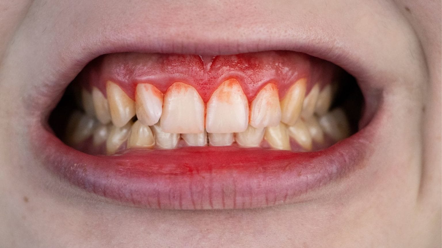 Gengivite Ulcerativa Necrosante Aguda (GUNA): O que é?